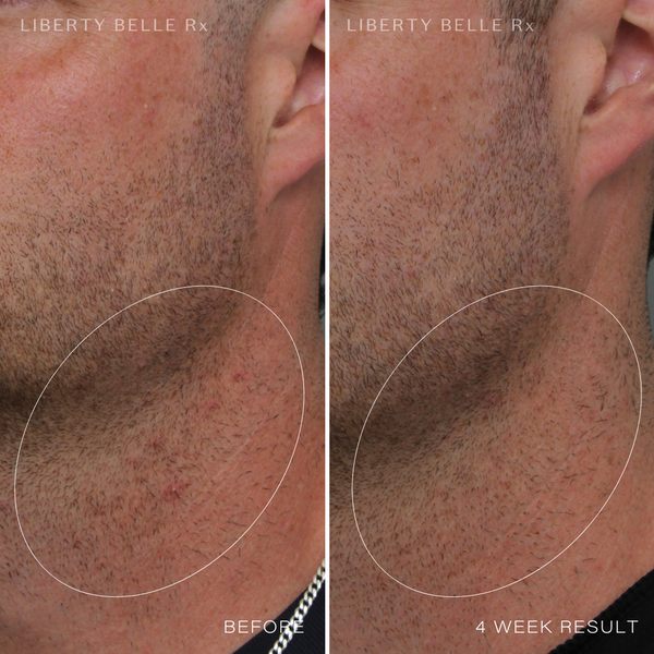 How To Achieve a Better Complexion – Bromance